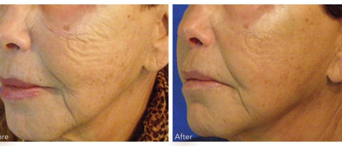 Voluderm RF Microneedling - Body & Soul Massage Therapy